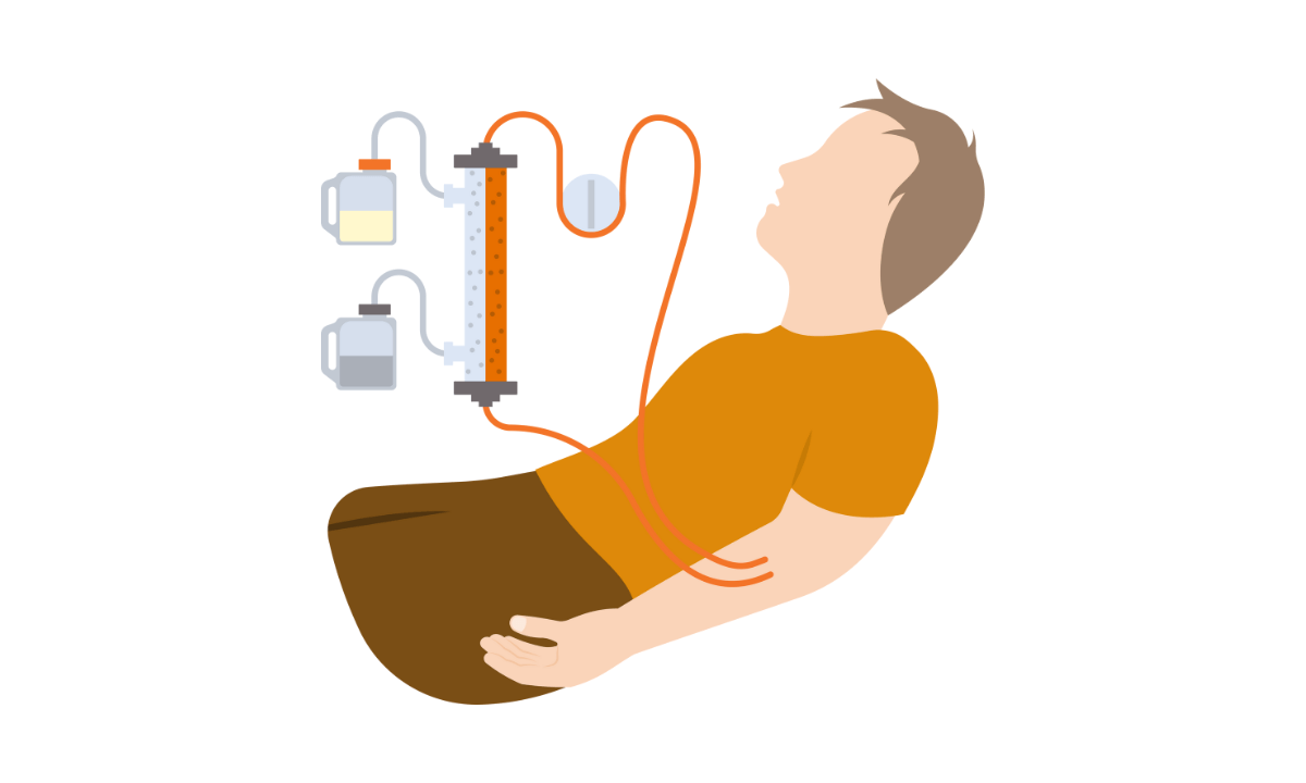 How to Mix Bicarbonate for Dialysis: A Step-by-Step Guide - Medocal Limited